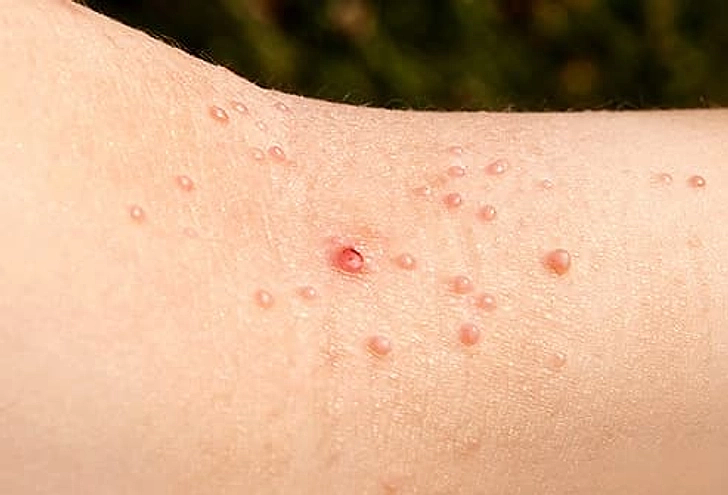 How to Remove Warts Safely Without Scars - North Penn Now