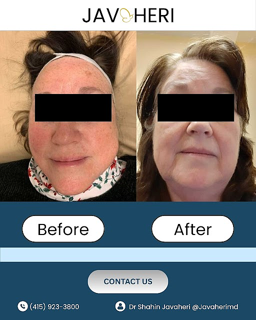 A Beginner’s Guide to Facial Rejuvenation Procedures - On Pattison ...