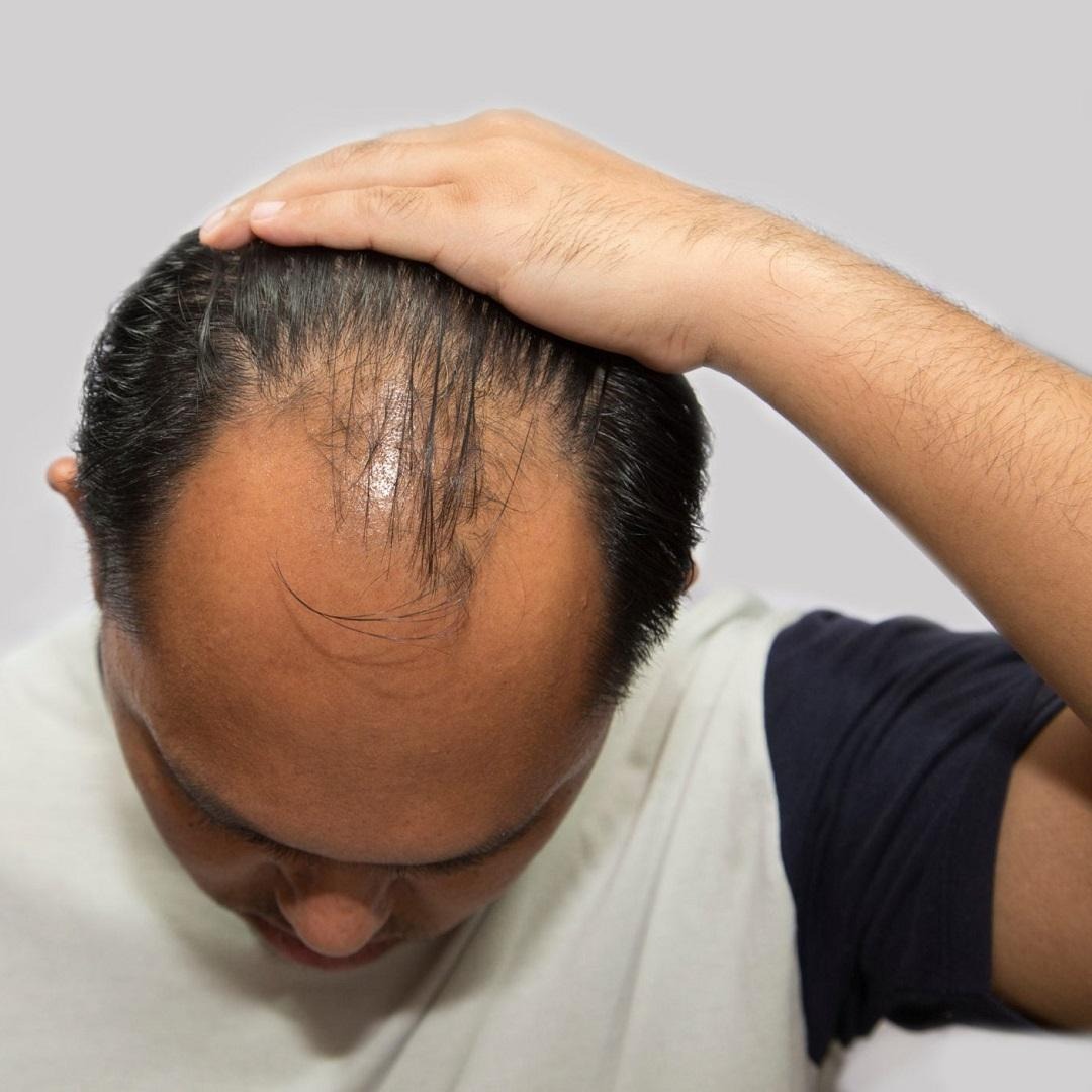 Can a Hair Transplant fix a receding hairline? - Breaking AC